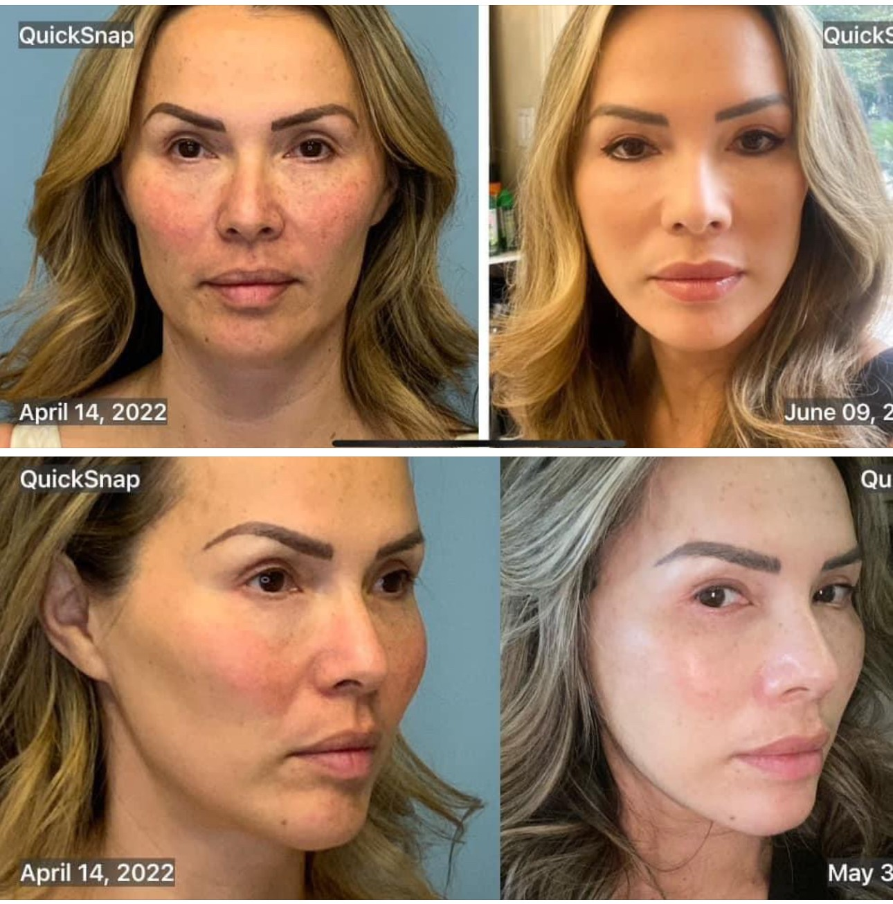 Deep Plane Facelift Cyrmdcosmeticsurgery